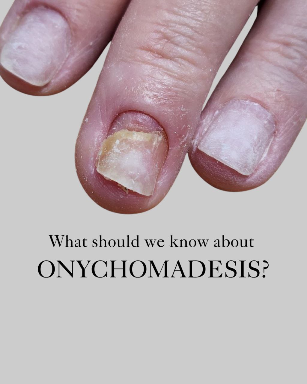 What You Should Know About ONYCHOMADESIS? – Splash of beauty